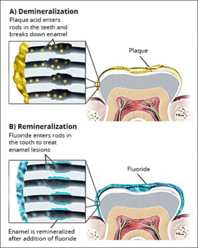 Fluoride Treatment - Gentle Dentistry