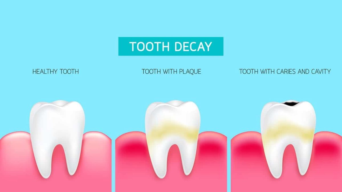 Do You Have Tooth Decay? Here's 5 Signs That You Might